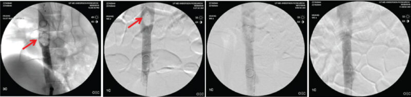 Technology - Absorbable Vascular Filter