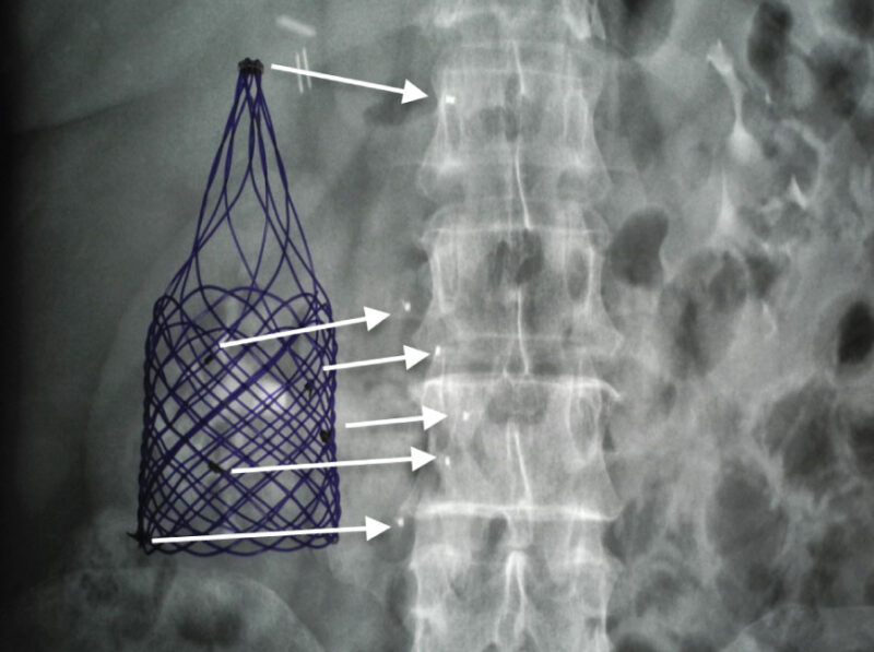 Technology - Absorbable Vascular Filter